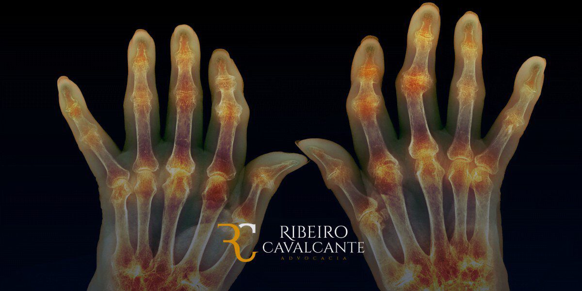 Artrite Reumatoide Grave: Auxílio-doença e Aposentadoria por Invalidez ...